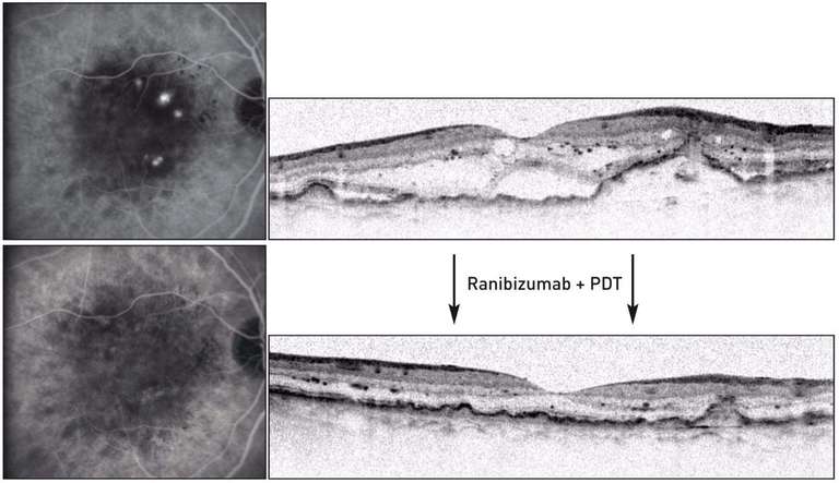 Vasculopathie polypoïdale : quel traitement en 2012?