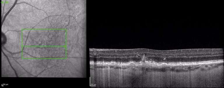 Bilatéralisation dans la DMLA exsudative