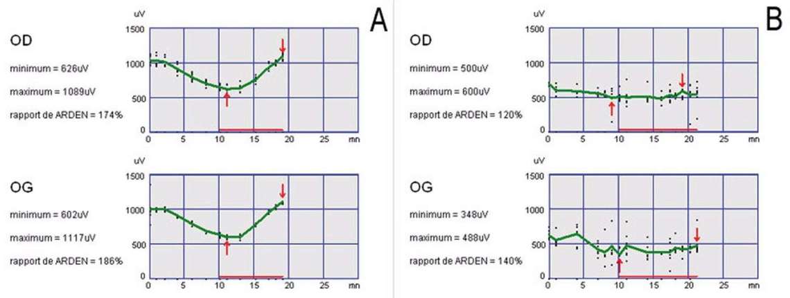 EOG sensoriel et PEV : qu’en attendre et quand les demander