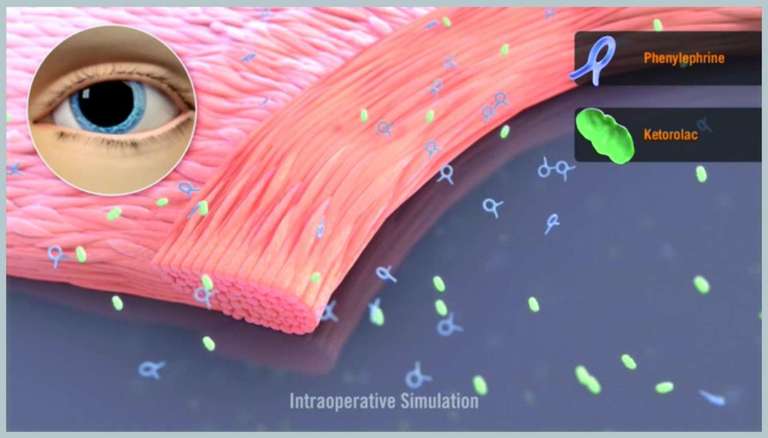 Omidria® bien toléré en chirurgie de la cataracte pédiatrique