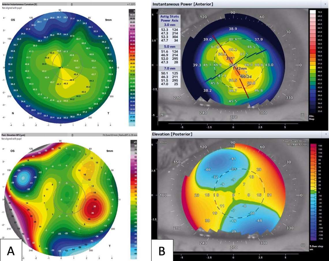 Topographie OCT : un nouveau standard