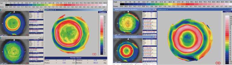 La nouvelle lentille de nuit Prevention