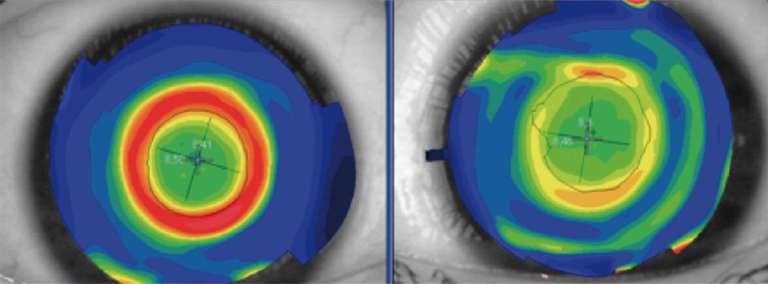 La nouvelle lentille de nuit Prevention